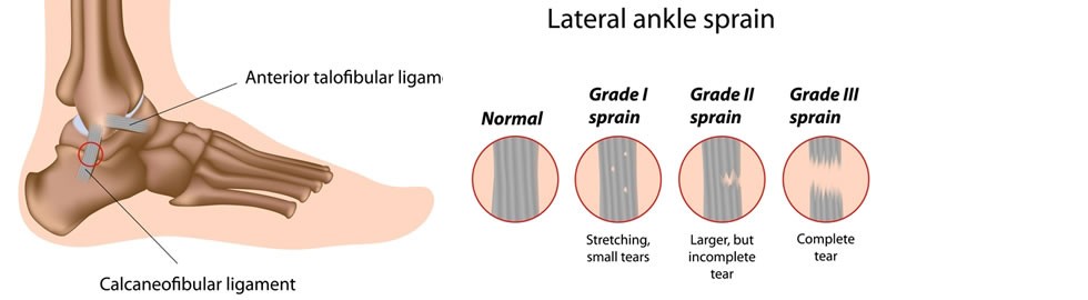 Tears Sprains Contusions – HSC PDHPE